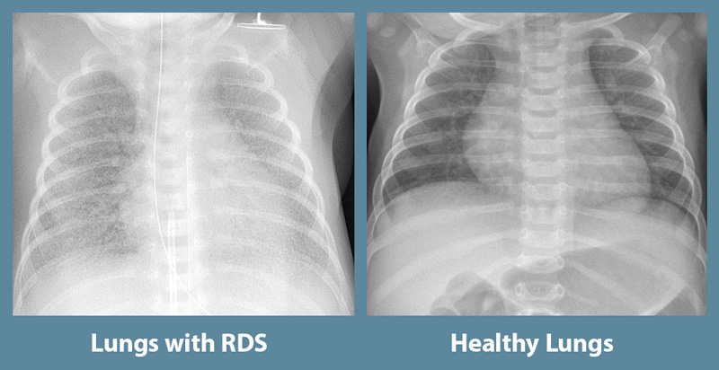 What Is RDS - NICU Connections